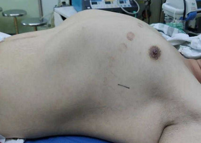 Exploring the Link Between COPD Progression and Barrel Chest ...